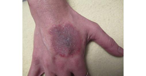 Study Cements Link Between Protean Morgellons Lesions and Lyme Disease.