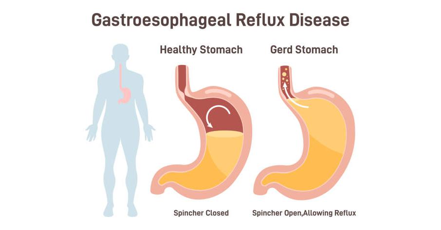Gastroesophageal Reflux Disease Treatment Devices Market Set to Surge ...