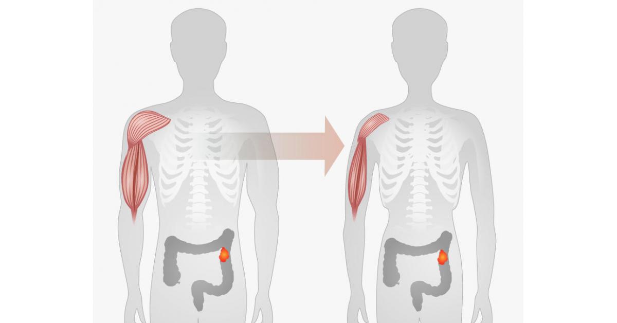 Cancer Cachexia Market Size Expansion to USD 4.03 Billion by 2032 ...