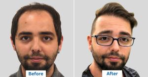 Turkey Cosmetic Surgery Tourism Hits USD 3.5B Annually as New Research ...